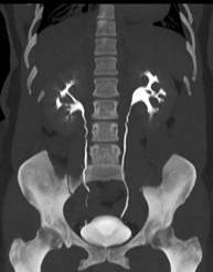 CT Urography-MH